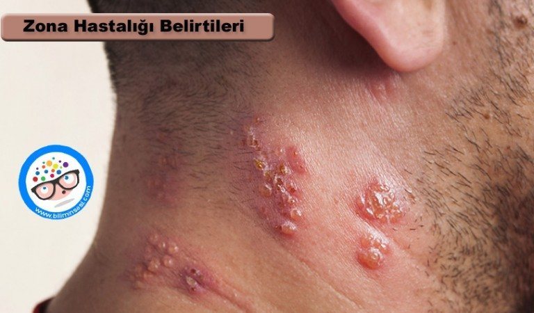 Zona Hastalığı Belirtileri – BiliminSesi | Sağlık ve Teknoloji