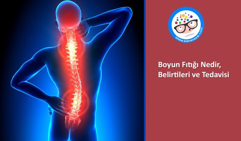 Boyun Fıtığı Nedir? Belirtileri ve Tedavi Yöntemleri – BiliminSesi ...